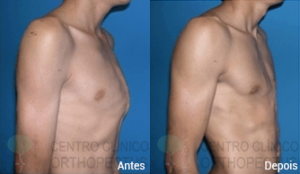 Sinais de Pectus Carinatum: Quando Procurar Ajuda - Orthopectus